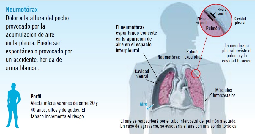 Neumotórax: síntomas y tratamiento