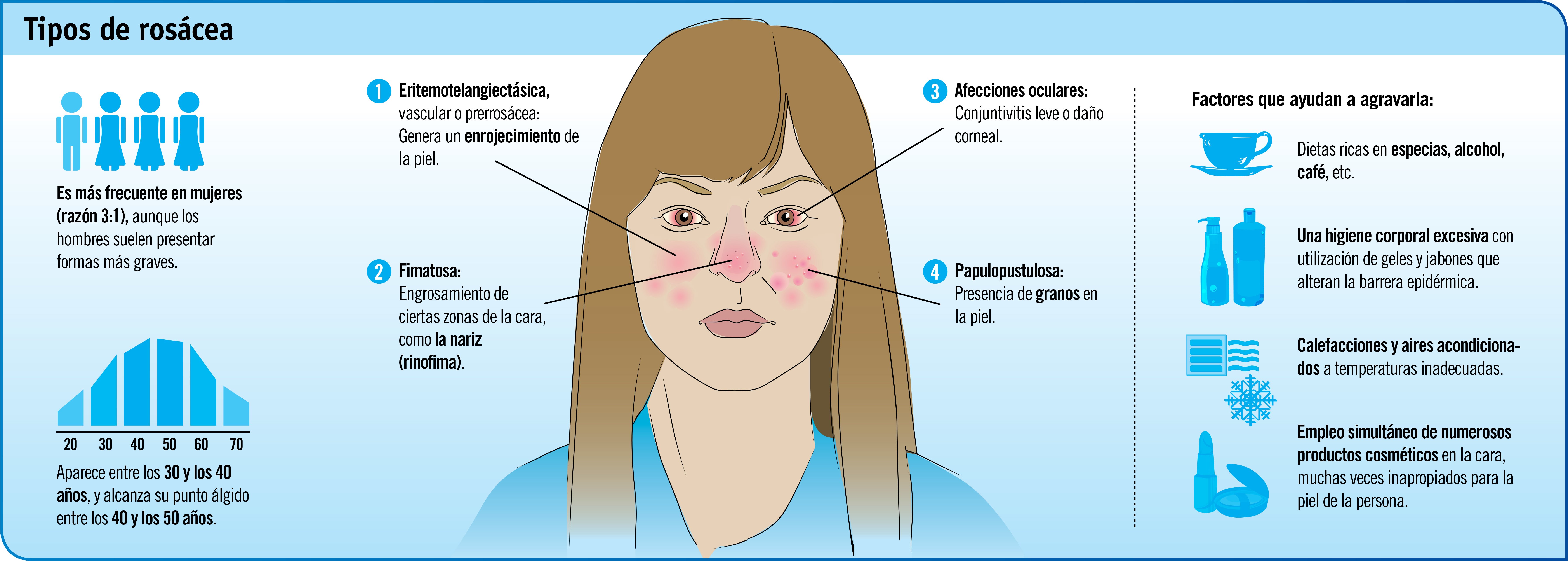 Rosácea: síntomas y tratamientos