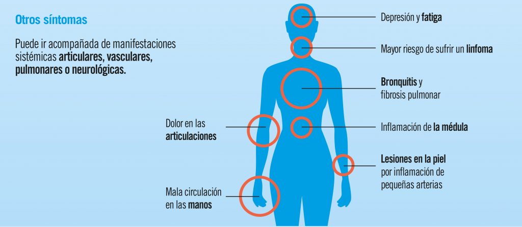 Síndrome De Sjögren Síntomas Diagnóstico Y Tratamiento